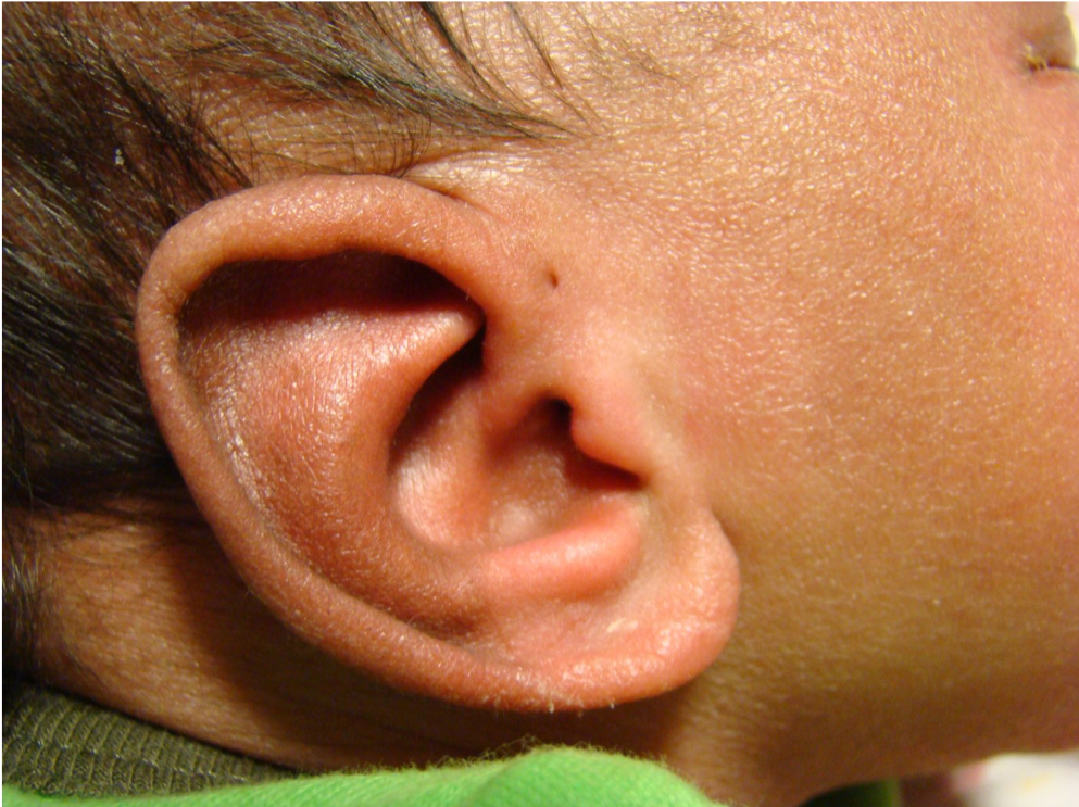 Pediatric Pearls: Infant's Ear - Pits, Tags, and the Pinna