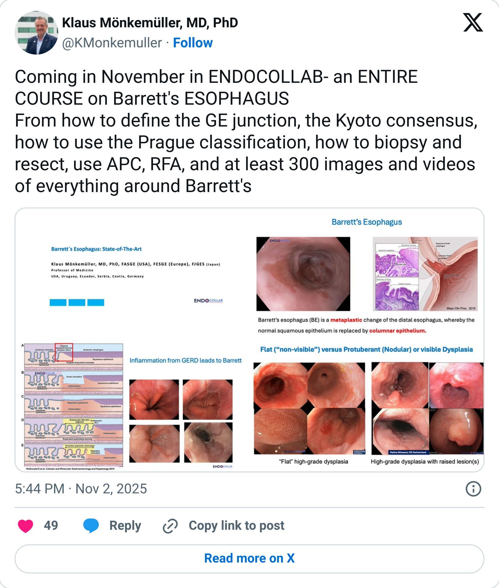 Hemostasis of Bleeding Duodenal Ulcer Using Injection Gold Probe