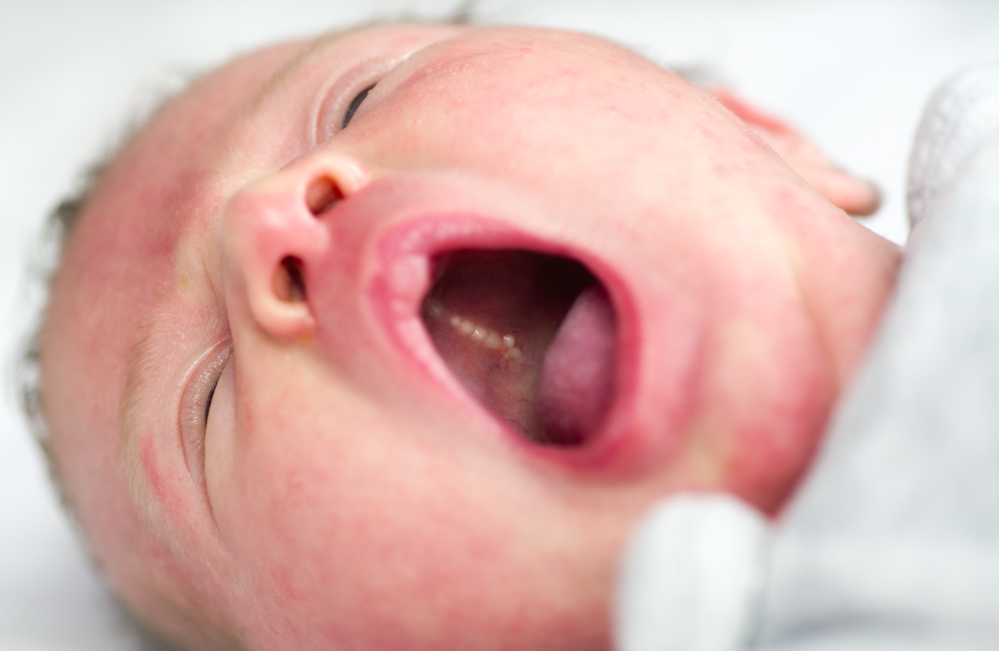 Pediatric Pearls: Infant's Mouth Part 1 - Blisters, Bumps and Clefts