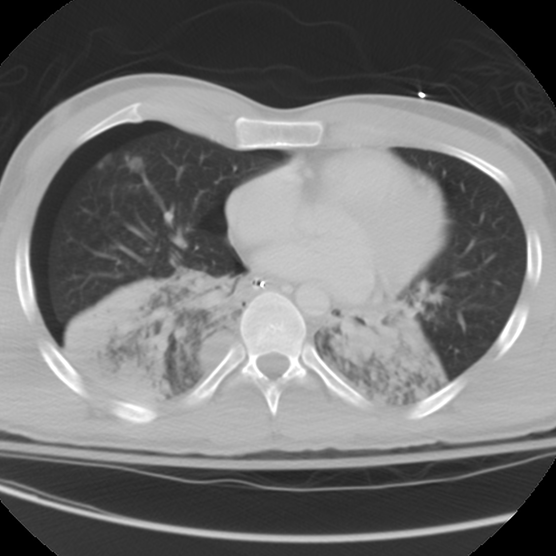 Pulmonary Contusions and Lacerations - by Alexander Baxter