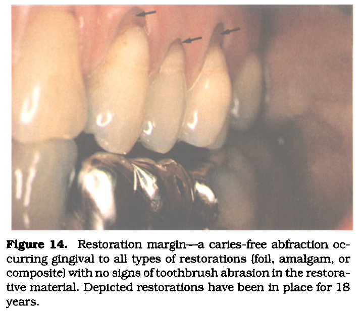 Abfractions: A New Classification of Hard Tissue Lesions of Teeth