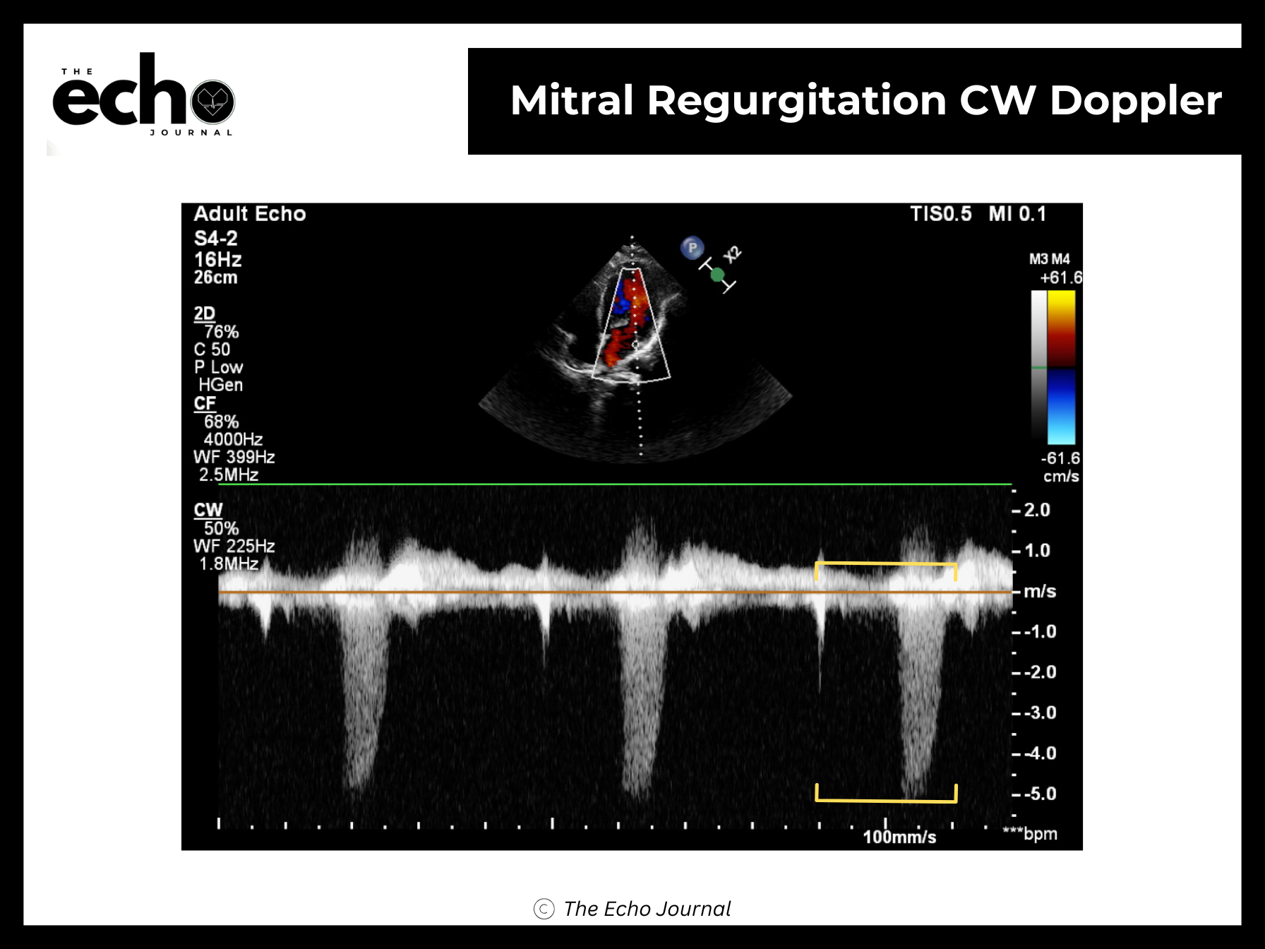 Mitral Regurgitation: PISA, Vena Contracta, Grading & Clinical Pearls