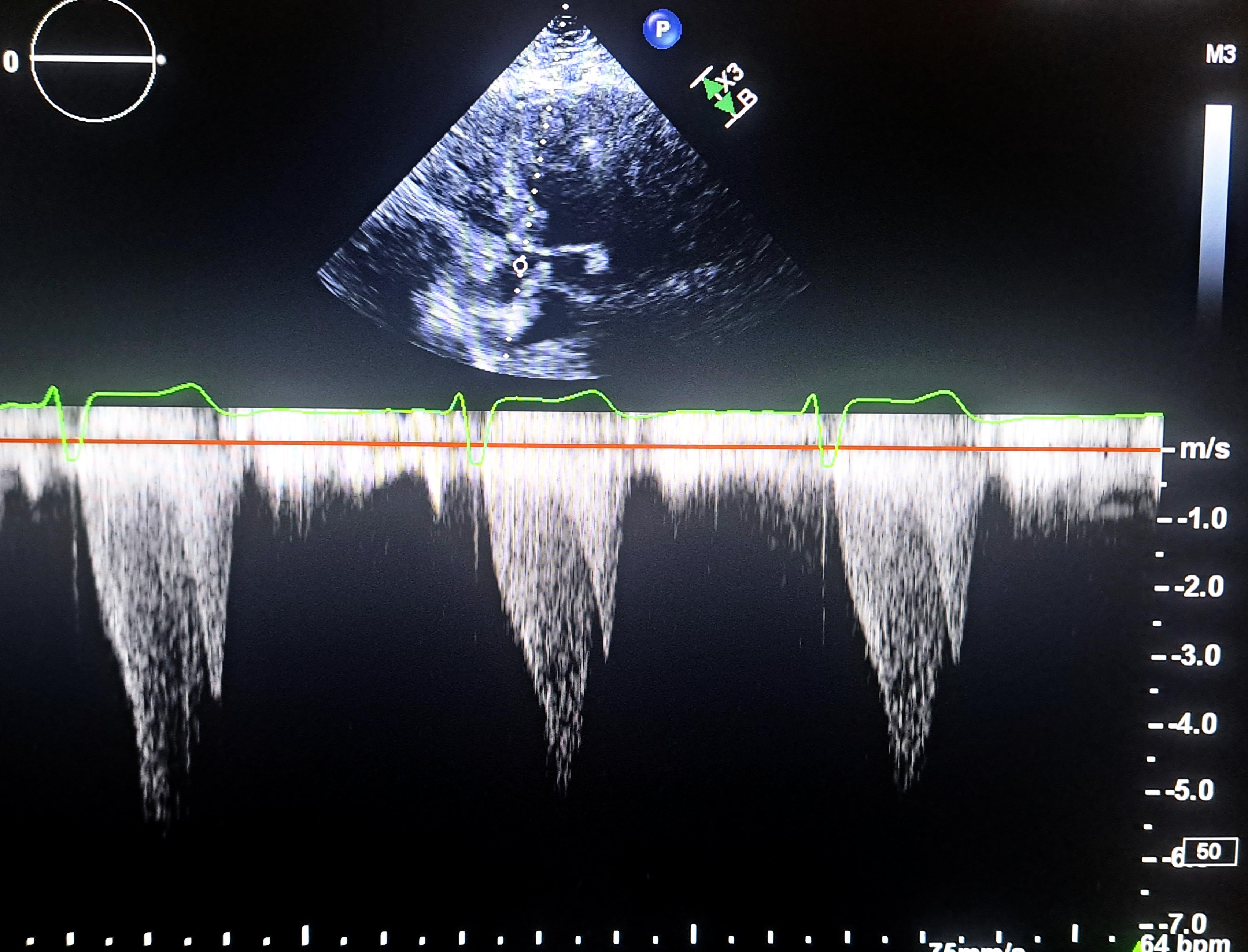When Waves Collide: A Guide to Sorting Out Doppler Drama