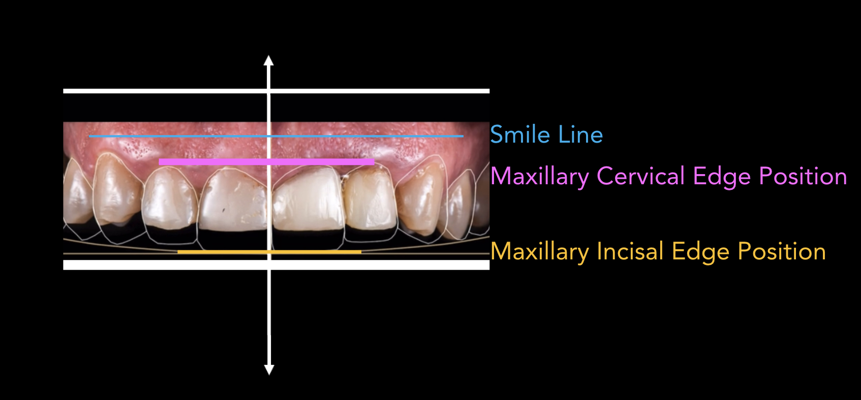 🦷 Raising the Bite: When, Why, and How to Increase VDO Without Guesswork