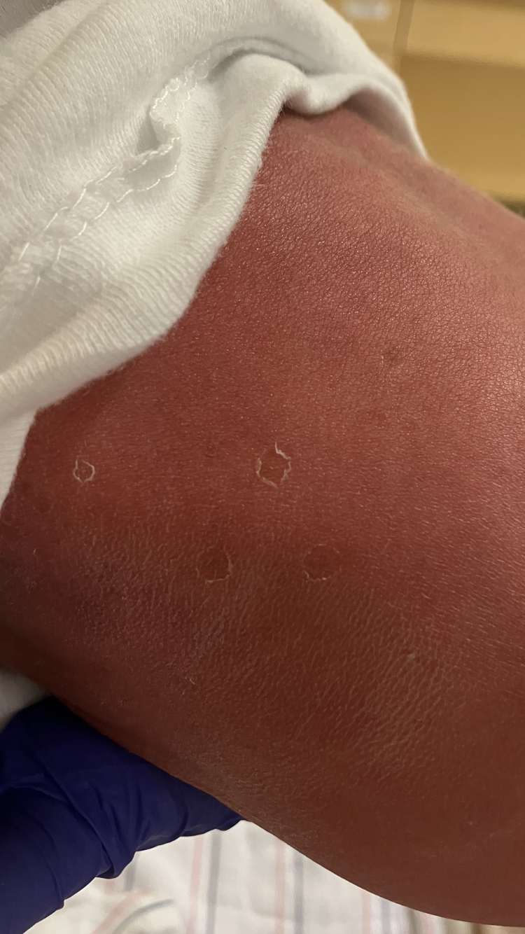 Pediatric Pearls. What's this rash?