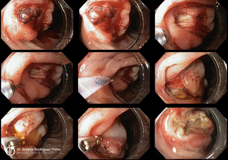 Endoscopic Management of Post-Sphincterotomy Bleeding: Eight Hemostatic ...