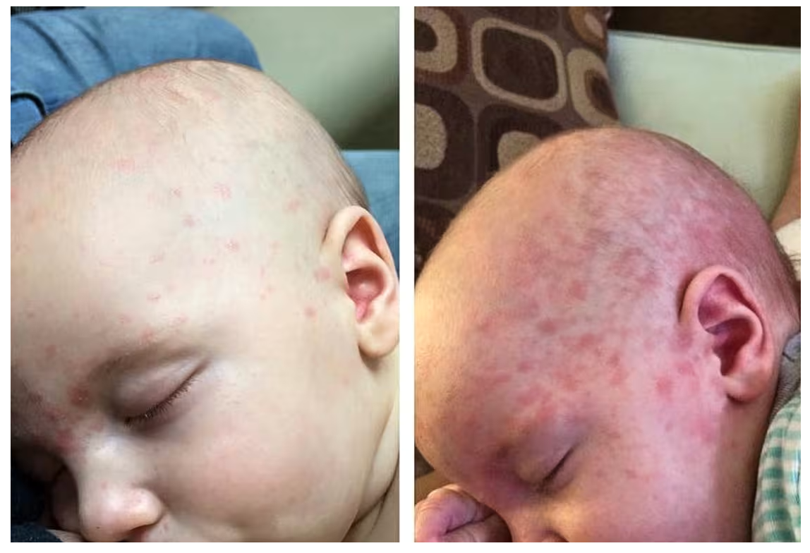 How measles affects babies: congenital measles, perinatal measles and measles during pregnancy