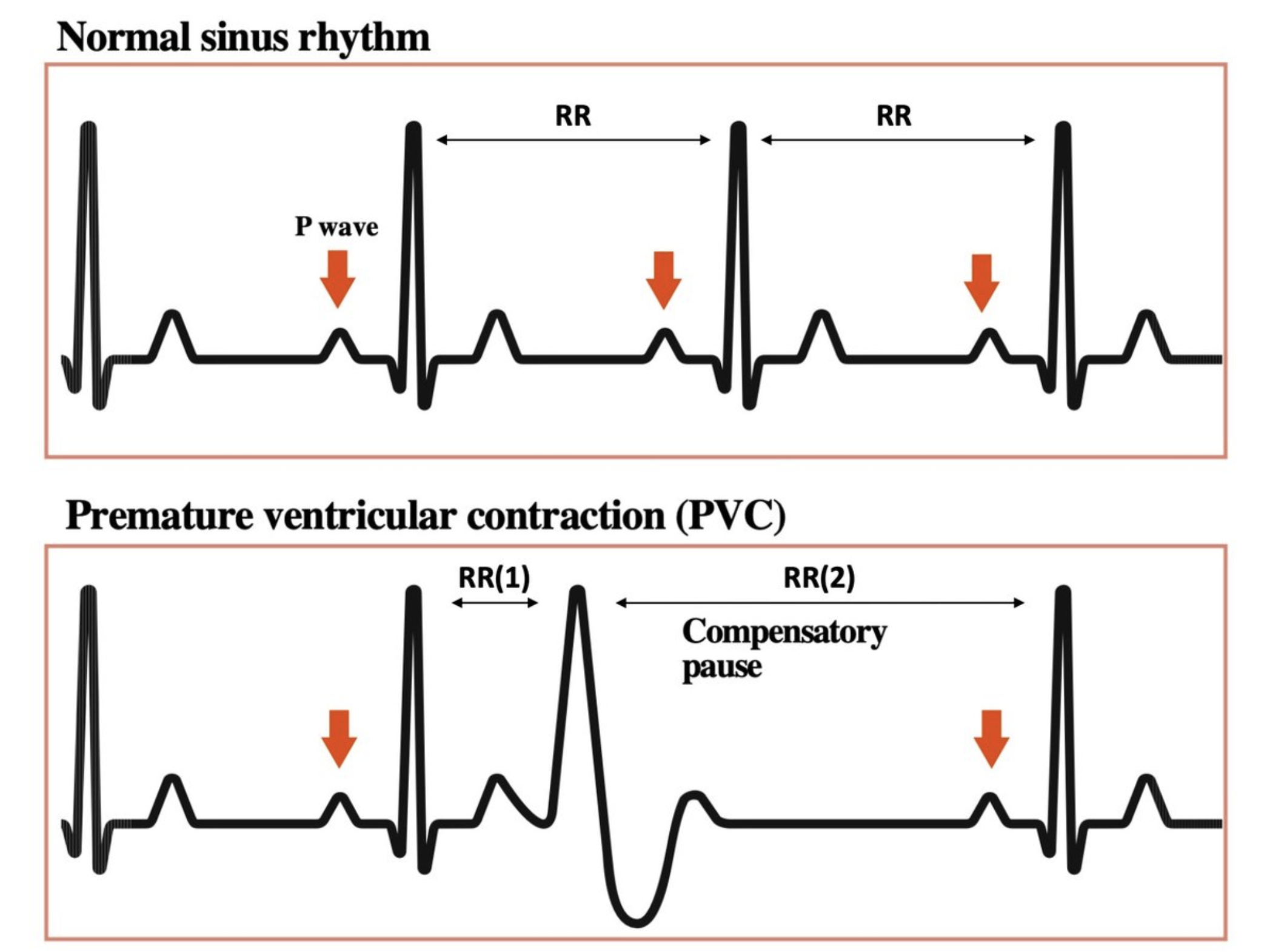 Premature complexes: atrial vs junctional vs ventricular