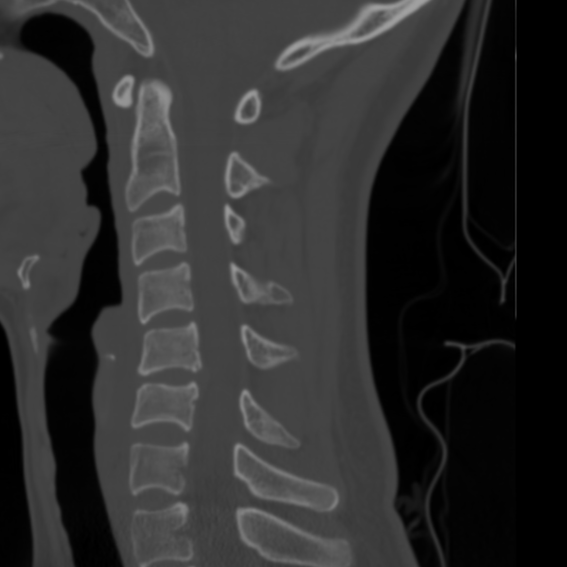 Cervical Spine Hyperflexion Injuries - by Alexander Baxter