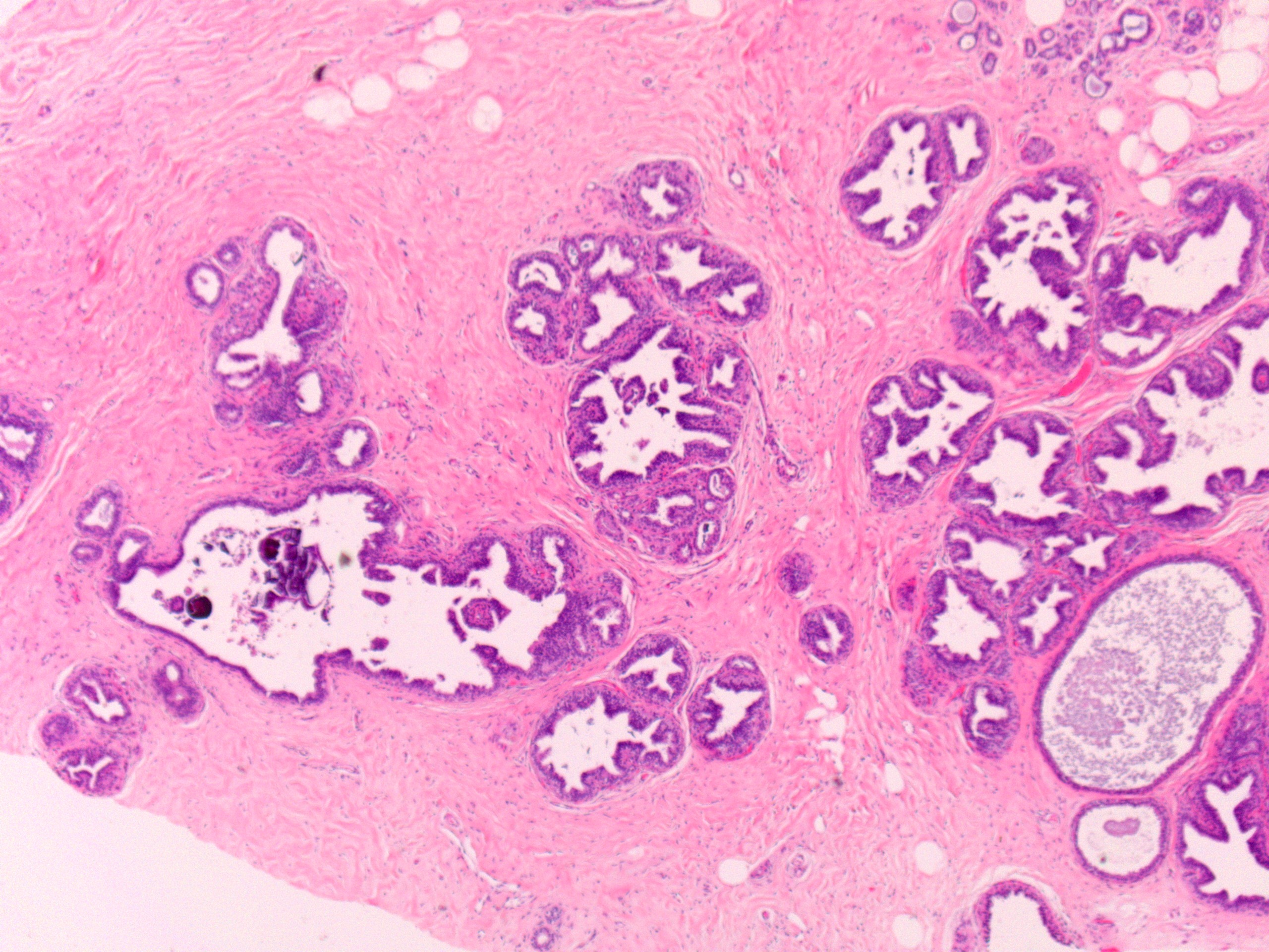 Columnar Cell Lesions - The Path Princess