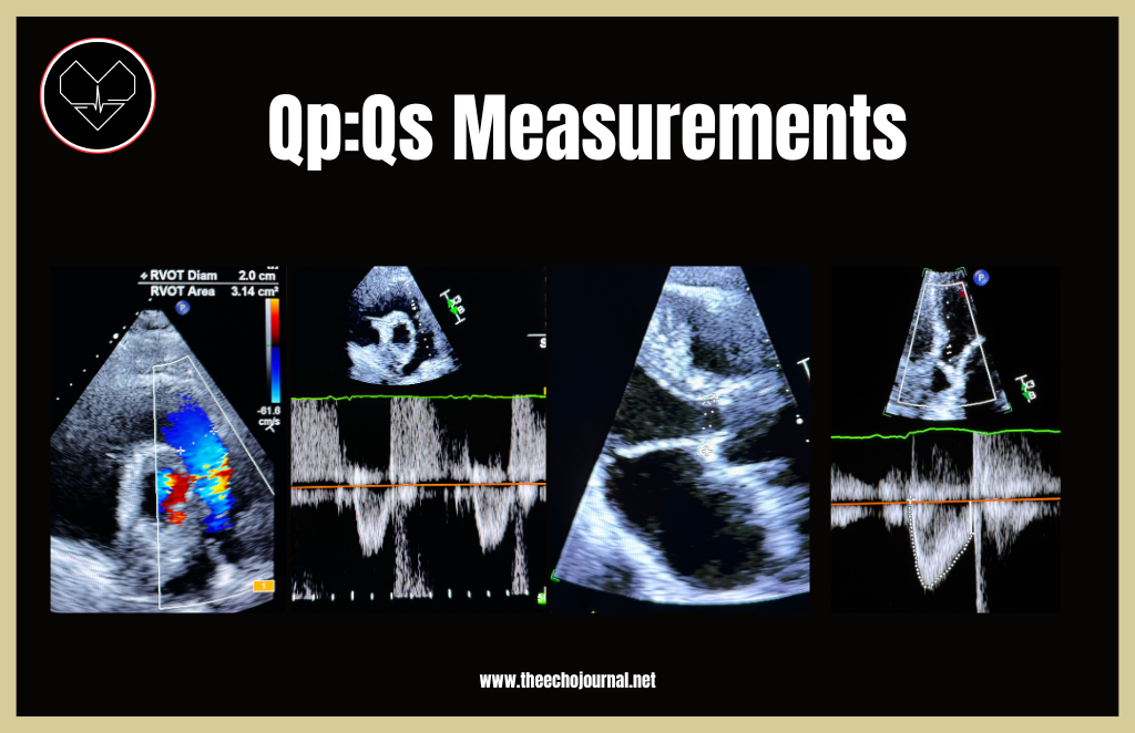 Atrial Septal Defect: Key Concepts Explained - by Aram K.