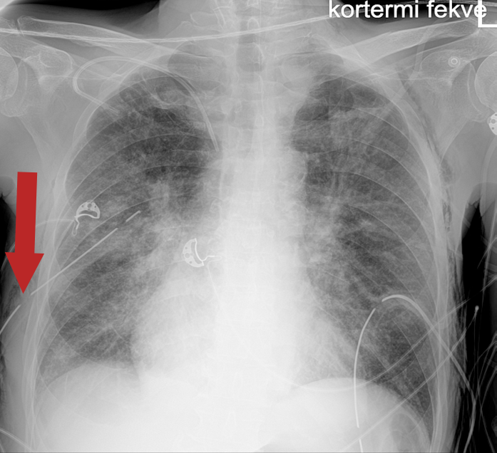 Chest Tubes & Pigtails: 5 Must-Know Tips for ICU Rotation
