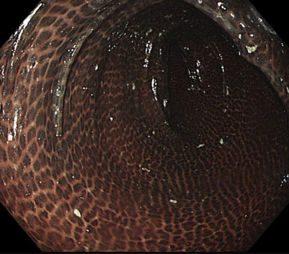 What Works for Constipation? A Review of 5 Common Treatments