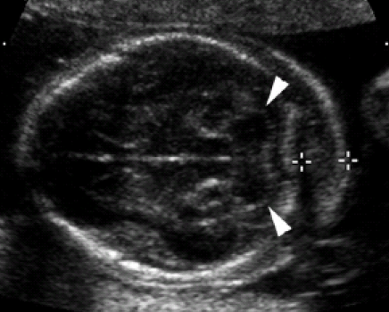 Fetal Ultrasound Soft Markers - Babies After 35