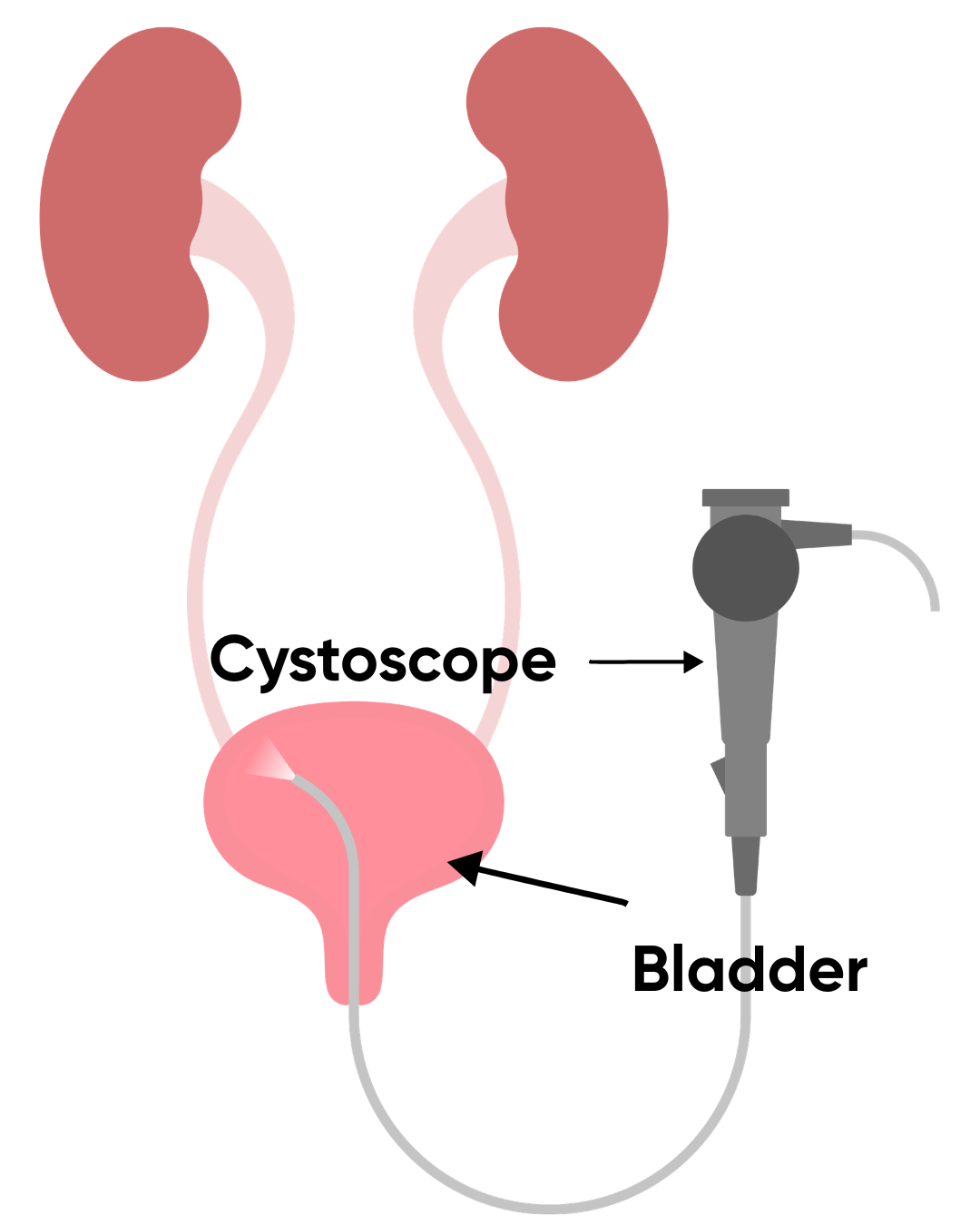 Is Cystoscopy Painful? A Urologist’s Guide to Safe Bladder Procedures ...