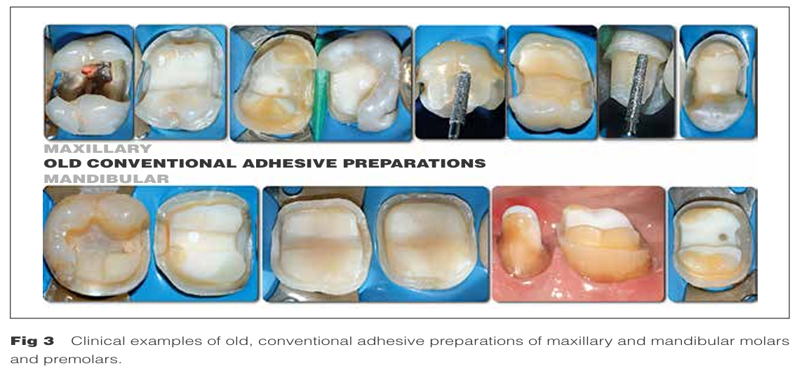 Posterior indirect adhesive restorations: updated indications and the ...