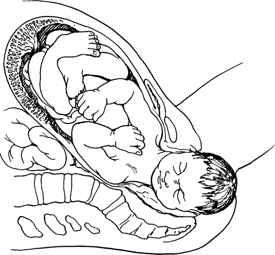 What happens if the baby gets stuck? - by Aubrey Shepherd