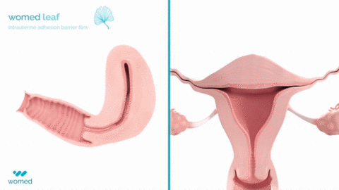 FDA approves Womed's first device for Asherman syndrome offering new ...