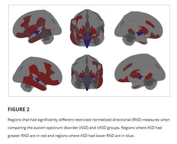 Are Autistic Brains Different From Neurotypical Brains?
