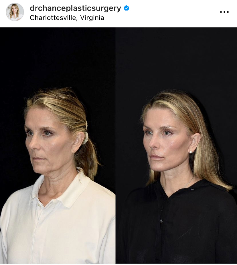 The Insta-Famous Facelift - by Jolene Edgar